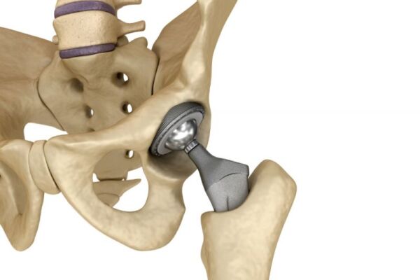 Hip Replacement Physiotherapy FAQ - Physio In Motion